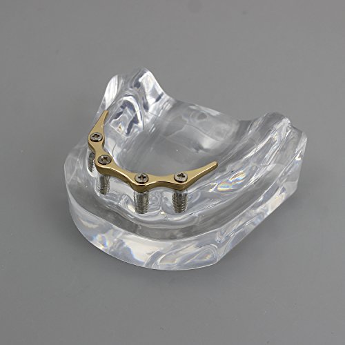 Dental Teeth Model Precision 4 Implant Overdenture Inferior Tooth Golden Color