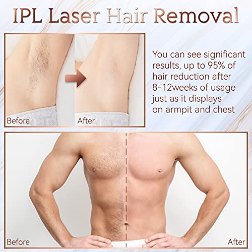 Aopvui At-Home IPL Hair Removal for Women and Men, Permanent Laser Hair Removal 999900 Flashes for Facial Legs Arms Whole Body Treatment