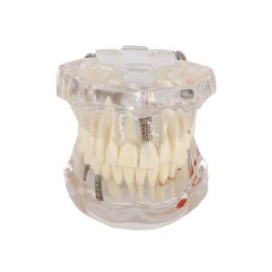 Smedent Dental Study Teaching Teeth Model Adult Typodont Model Removable Tooth