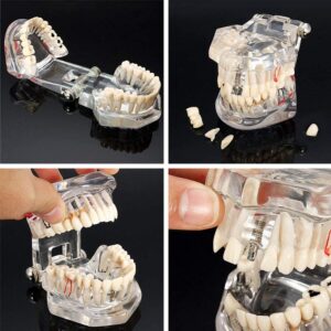 Smedent Dental Study Teaching Teeth Model Adult Typodont Model Removable Tooth