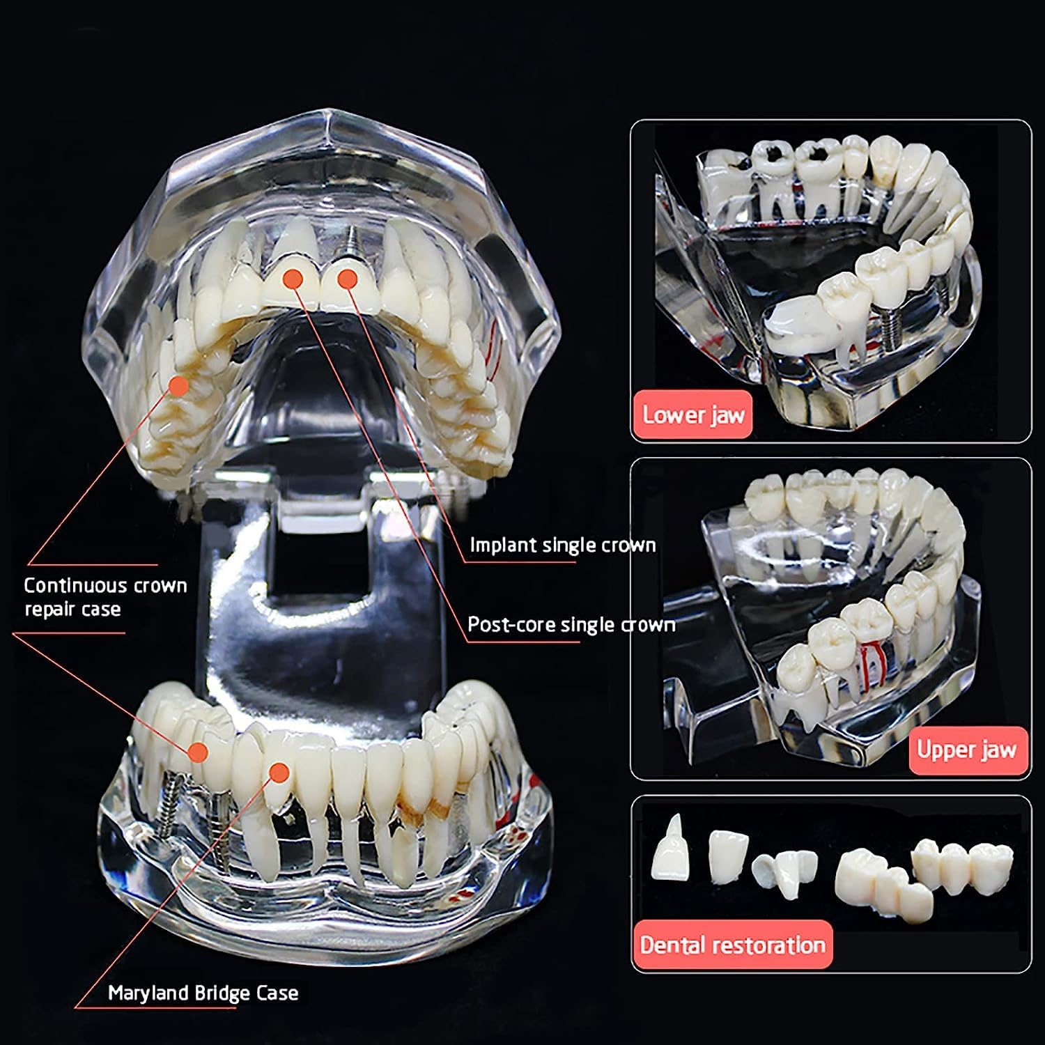 Smedent Dental Study Teaching Teeth Model Adult Typodont Model Removable Tooth