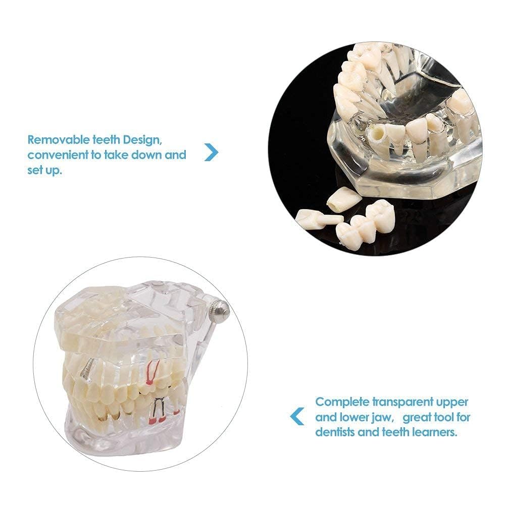 Smedent Dental Study Teaching Teeth Model Adult Typodont Model Removable Tooth