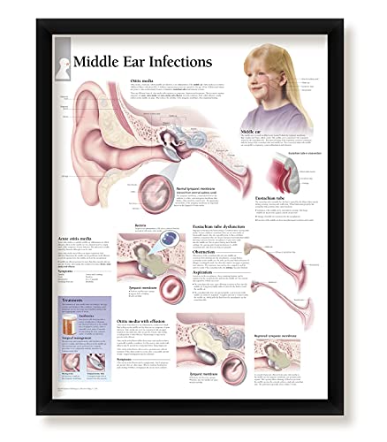 Set of 4 Framed Medical Posters Ear, Nose and Throat, Understanding Sinusitis, Understanding Rhinitis, and Middle Ear Infections 22"x28" Wall Diagrams