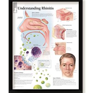 Set of 4 Framed Medical Posters Ear, Nose and Throat, Understanding Sinusitis, Understanding Rhinitis, and Middle Ear Infections 22"x28" Wall Diagrams