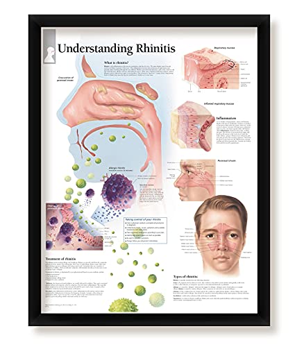 Set of 4 Framed Medical Posters Ear, Nose and Throat, Understanding Sinusitis, Understanding Rhinitis, and Middle Ear Infections 22"x28" Wall Diagrams