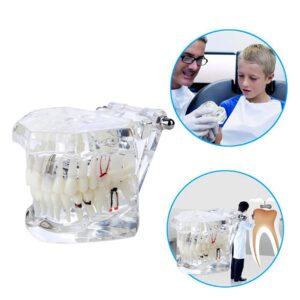 Dentalmall Dental Oral Typodont Model Implant Pathological Removable Teach Demo Visible Anatomy Demonstration Teaching Standard Size (Clear)