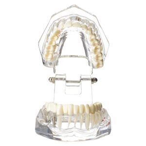 Dentalmall Dental Oral Typodont Model Implant Pathological Removable Teach Demo Visible Anatomy Demonstration Teaching Standard Size (Clear)