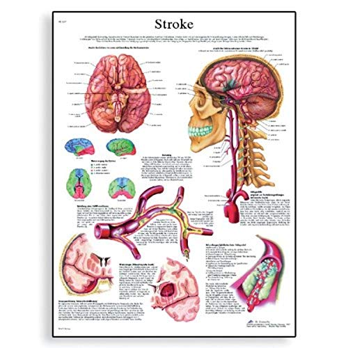 3B Scientific VR1627L Glossy Laminated Paper Stroke Anatomical Chart, Poster Size 20" Width x 26" Height