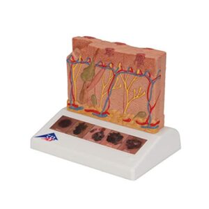 3B Scientific J15 Skin Cancer Model - 3B Smart Anatomy