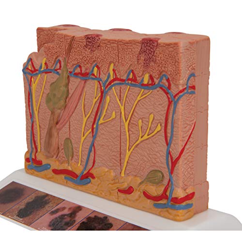 3B Scientific J15 Skin Cancer Model - 3B Smart Anatomy