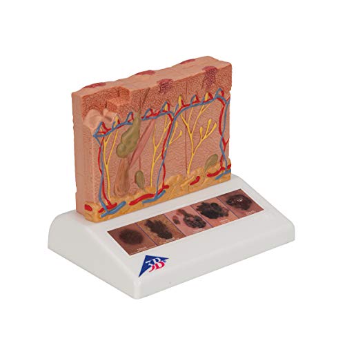 3B Scientific J15 Skin Cancer Model - 3B Smart Anatomy