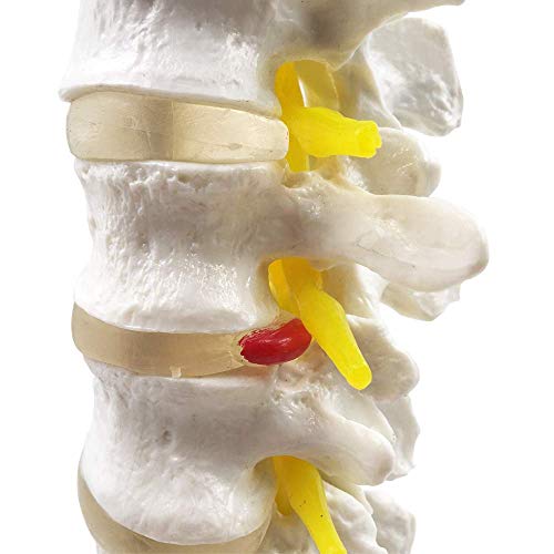 Wellden Product Medical Anatomical Model Lumbar Vertebrae w/ Sacrum & Coccyx, with Herniation Disc