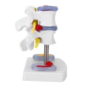 wene human spine model, professional vivid lumbar model clearly study with 2 diseased intervertebral discs for school