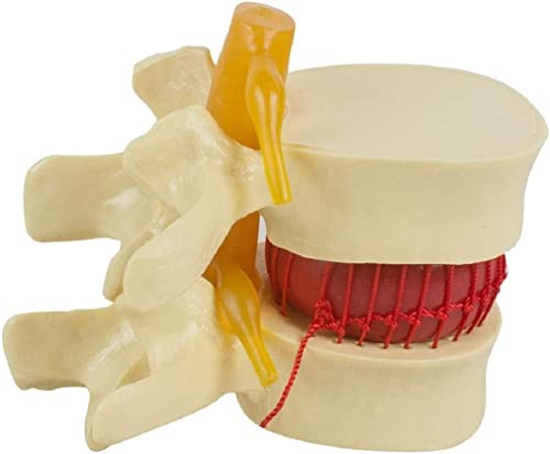 1PCS Anatomical Human Lumbar Vertebrae Degenerative Lumbar Human Spine Model (Yellow)