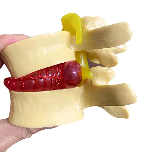 1PCS Anatomical Human Lumbar Vertebrae Degenerative Lumbar Human Spine Model (Yellow)