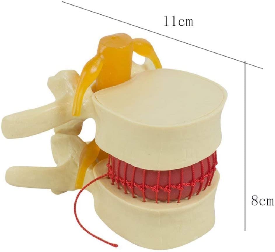 1PCS Anatomical Human Lumbar Vertebrae Degenerative Lumbar Human Spine Model (Yellow)