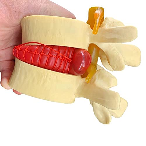 1PCS Anatomical Human Lumbar Vertebrae Degenerative Lumbar Human Spine Model (Yellow)