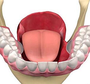 Lower Denture Stabilizers