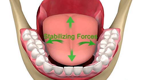 Lower Denture Stabilizers