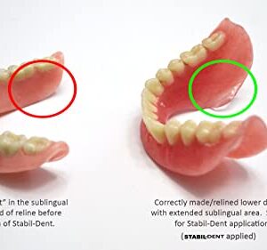 Lower Denture Stabilizers