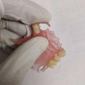 "Nesbit bridge" , Flipper Uppler and Lower Set of Affordability Flexible Valplast Customized Partial Denture (Pink, Valplast)