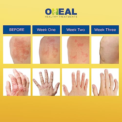 OHEAL Manuka Honey Eczema Cream, Eczema Psoriasis Shingles Honey Cream for Dry Skin, One Bottle for Dermatitis Cream, Psoriasis Treatment for Skin, Eczema Honey for Ringworm Treatment, 3.4 oz