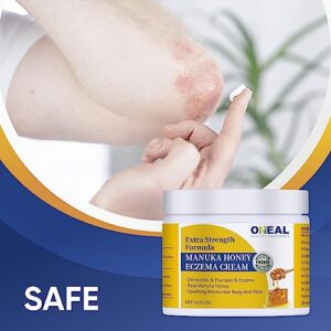 OHEAL Manuka Honey Eczema Cream, Eczema Psoriasis Shingles Honey Cream for Dry Skin, One Bottle for Dermatitis Cream, Psoriasis Treatment for Skin, Eczema Honey for Ringworm Treatment, 3.4 oz