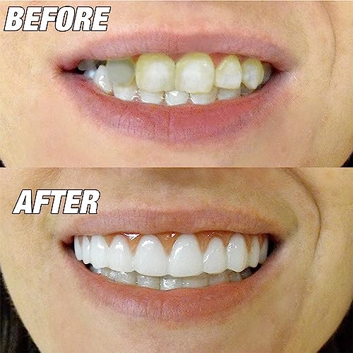 Fake Teeth, 2 PCS Veneers Dentures Socket for Women and Men, Dental Veneers for Temporary Tooth Repair Upper and Lower Jaw, Protect Your Teeth and Regain Confident Smile, Professional Cosmetic (2)