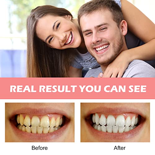 Fake Teeth, 2 PCS Veneers Dentures Socket for Women and Men, Dental Veneers for Temporary Tooth Repair Upper and Lower Jaw, Protect Your Teeth and Regain Confident Smile, Bright White-5-5