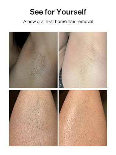 Ulike Laser Hair Removal for Women and Men, Air 3 IPL Hair Removal with Sapphire Ice-Cooling System for Nearly Painless & Long-Lasting Result, Flat-Head Window for Body & Face at-Home Use