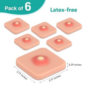 Ultrassist Abscess I&D Incision and Drainage Pad (6-Pack), Sebaceous Cyst Removal Trainer, Suture Practice Skin Pad for Medical Education