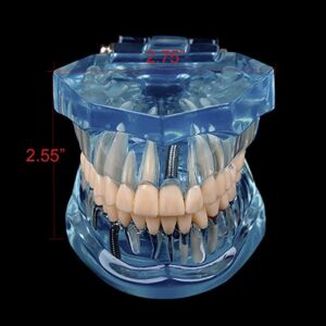 Dental Implant Model Teeth Typodont Model Dental Implant Restoration Training Tooth Pathologies Disease Demonstration Removable Teeth Teaching Studying