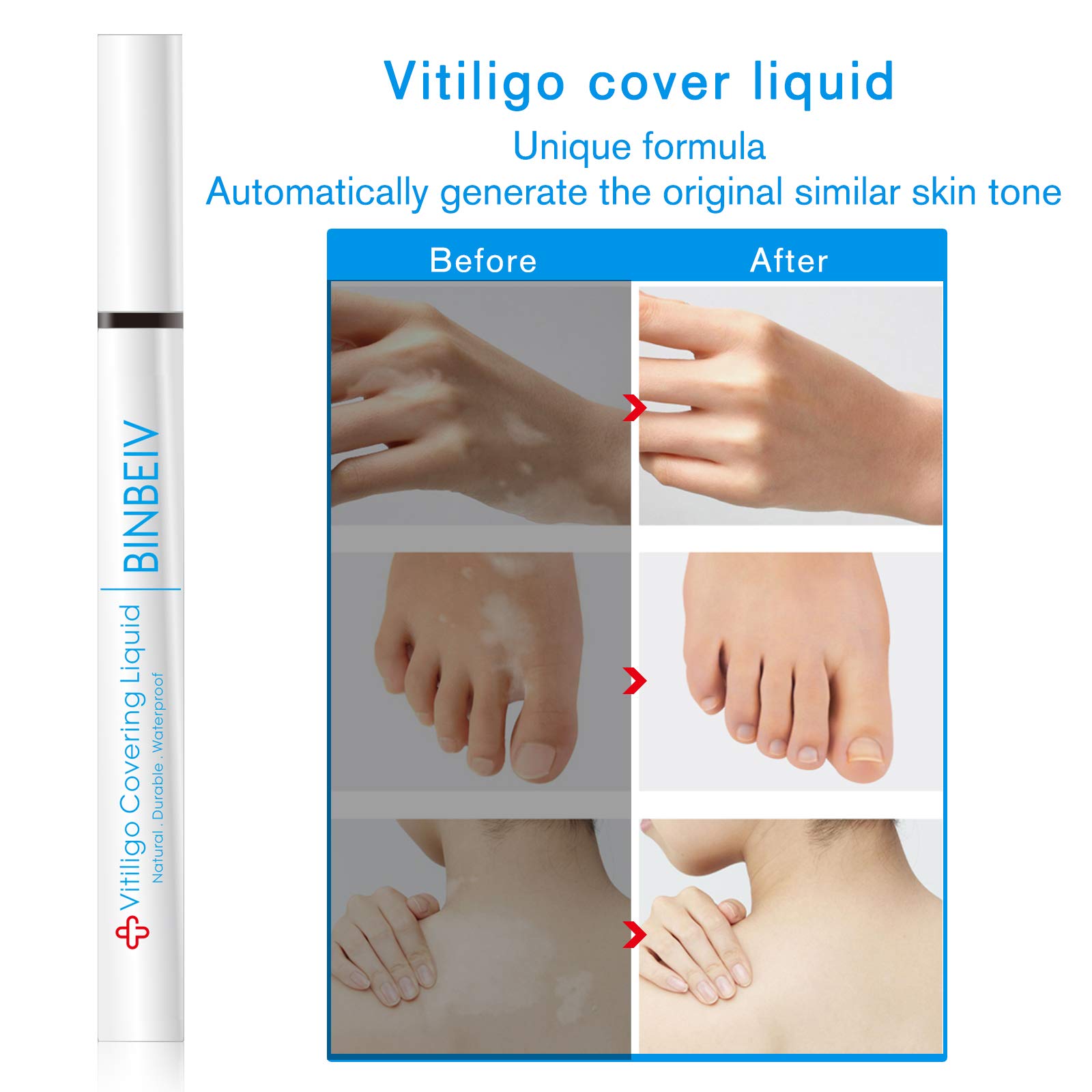 BINBEIV Vitiligo Cosmetic Camouflage Liqui, Cover appearance of Skin Depigmentation, Natural-Durable-Waterproof, Makeup Cover Waterproof, Used on face, hands and body