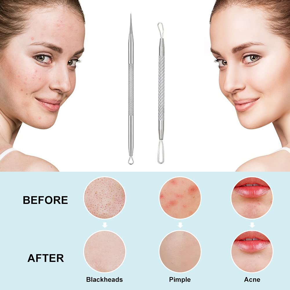 Blackhead Remover, 2 PCS Pimple Popper ，Stainless Steel Pimple Extractor Blackhead Removal Tool Risk Free Treatment for Blemish,Whitehead Popping