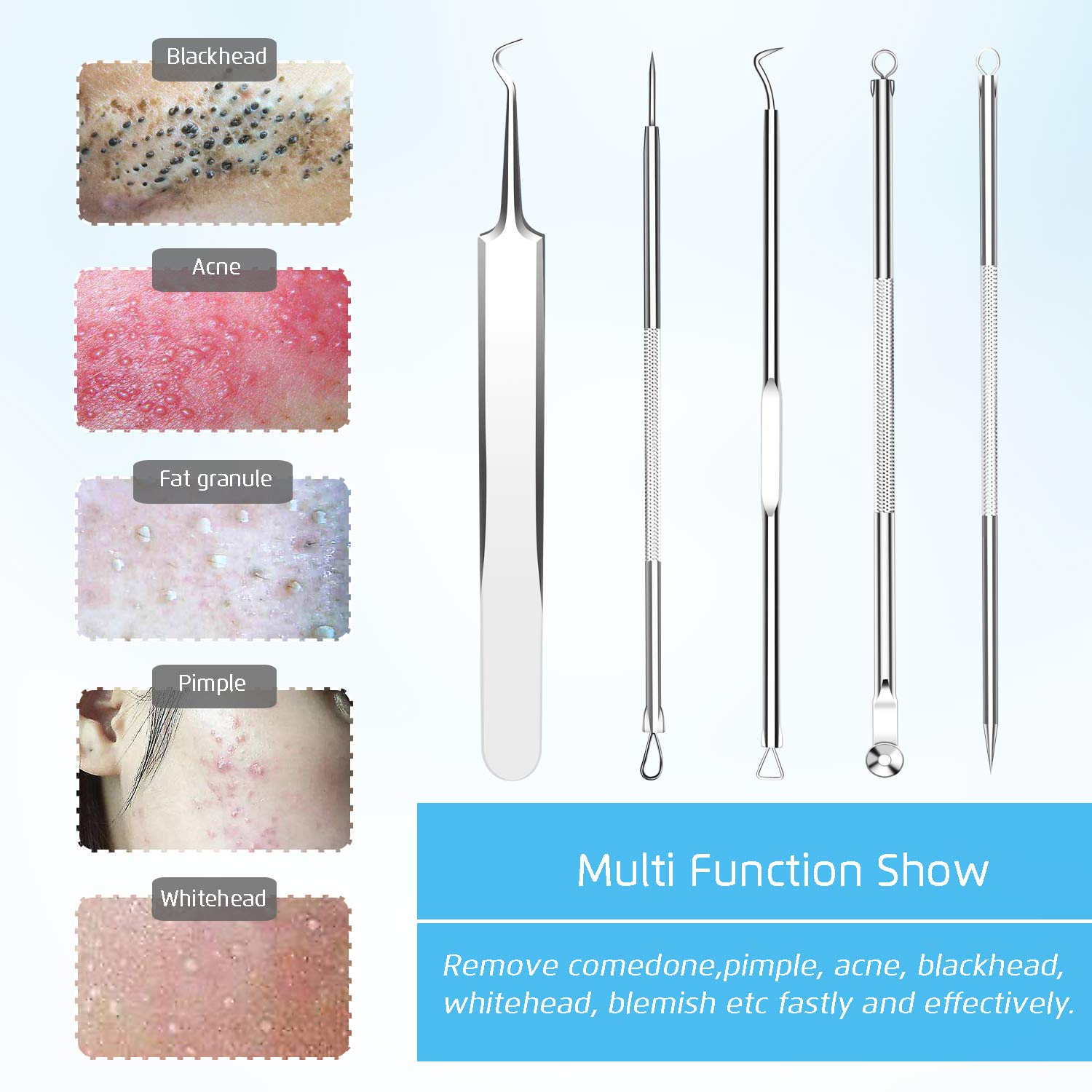 Premium Blackhead Remover, Comedone Blemish Acne Extractor,Popping Pimple Popper Whitehead Removal, Precision Tweezers, Zit Removing, Milia Remove