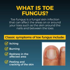 Fungi-Nail Anti-Fungal Liquid Solution, Kills Fungus That Can Lead to Nail & Athlete’s Foot with Tolnaftate & Clinically Proven to Cure and Prevent Fungal Infections 1 Fl Oz (Pack of 2)