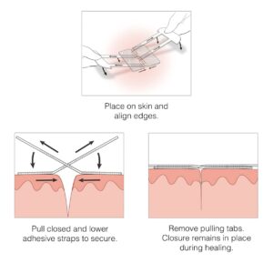 Clozex Complete Emergency Laceration Kit - Repair Wounds Without Stitches. FDA Cleared Skin Clean Cover Closure Device for 2 Individual Or Combine for 2 1/2 in. Length