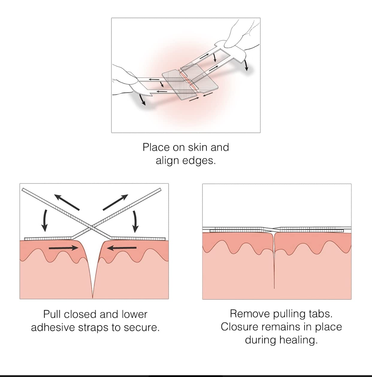 Clozex Complete Emergency Laceration Kit - Repair Wounds Without Stitches. FDA Cleared Skin Clean Cover Closure Device for 2 Individual Or Combine for 2 1/2 in. Length