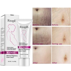 scars removal cream, mango remove pregnancy scars cream stretches marks treatment maternity repair firming skin