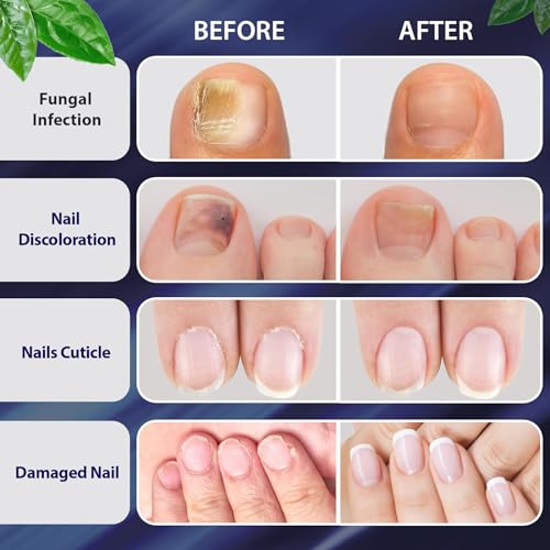 Tobcharm Toenail Fungus Treatment Extra Strength, Nail Fungus Treatment for Toenail, Fungus Nail Treatment, Nail Fungus Treatment for Fingernails (1oz)