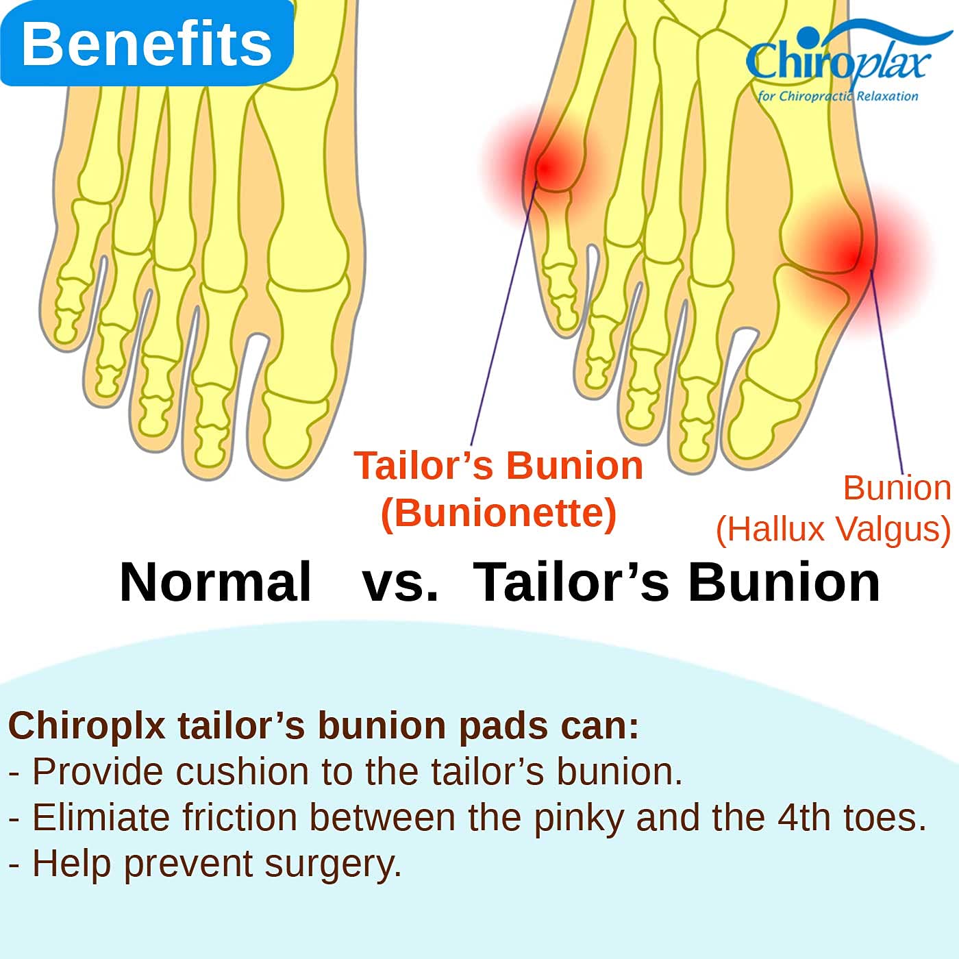 Chiroplax Tailor's Bunion Corrector Pads Bunionette Pain Relief Pinky Little Toe Straightener Separator Cushion Splint Protector Shield Spacer Cover Guard (4 Pads, Shims -Small)