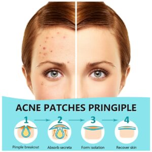 180 Counts Pimple Patches for Face Hydrocolloid Acne Patches for face Invisible Zit Patches for Face Pimple Patch Acne Spot Treatment Patch Blemish Patches Cover Patches Stickers