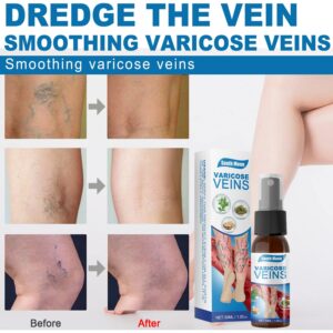 OUKPANE 2pcs Veinhealing Varicose Veins Treatment Spray, Veinhealing Varicose Veins Spray, Vein Healing Varicose Veins Treatment Spray for Legs, Varicose Veins Miracle Spray (30ml)