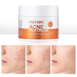 acne treatment for face, acne cream back acne treatment cream for teens & adults anti-acne pimple cream butt acne clearing cream, acne spot treatment