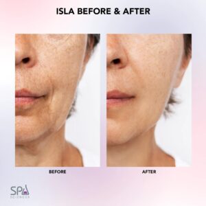 Spa Sciences ISLA Ice + Heat Contouring Roller (Face, Neck, and Décolletage) – Including Steel + Bonus Genuine Rose Quartz Globes