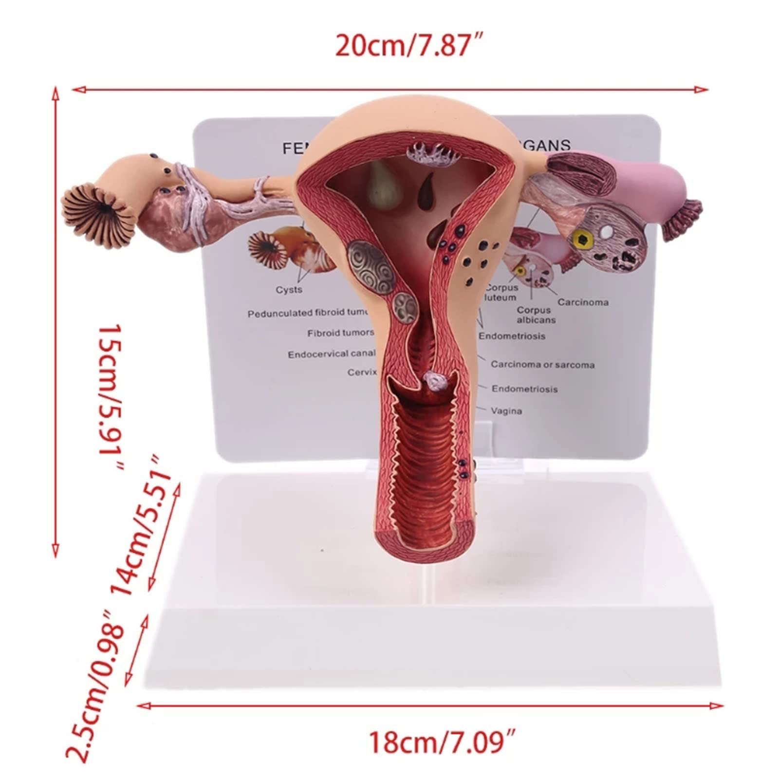 Uterus and Ovary Model, Human Anatomical Model Pathological Female Reproductive Organ Model for School Teaching Demonstration, Educational Tool