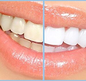 Lornamead 5 Minute Tooth Whitening System