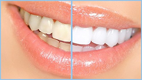 Lornamead 5 Minute Tooth Whitening System