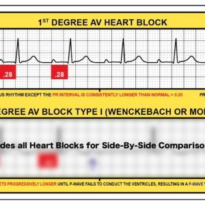 R-CAT for Arrhythmias EKG Pocket Reference Guide – Great Study Card for EKG Interpretation - ACLS and PALS Training – Cardiac Rhythm Interpretation Made Easy