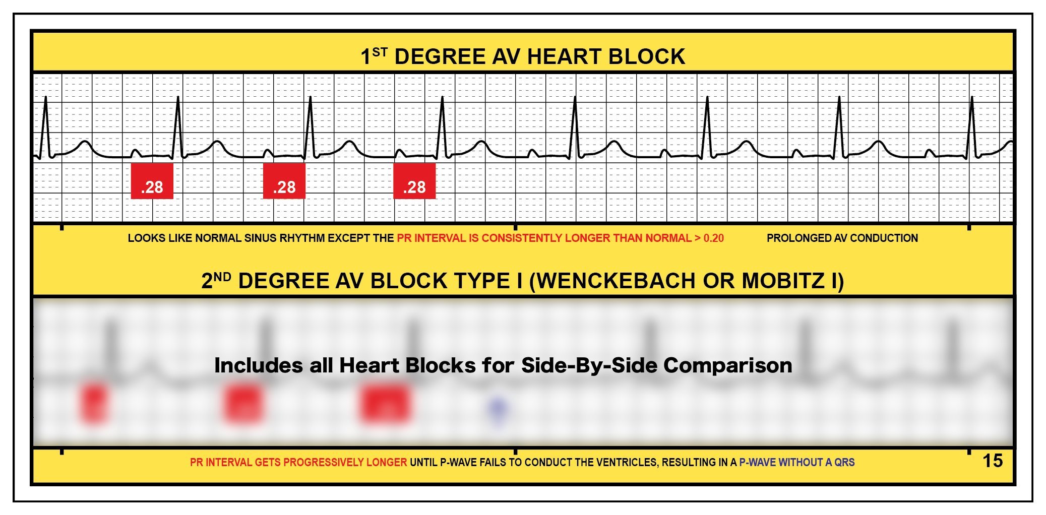 R-CAT for Arrhythmias EKG Pocket Reference Guide – Great Study Card for EKG Interpretation - ACLS and PALS Training – Cardiac Rhythm Interpretation Made Easy